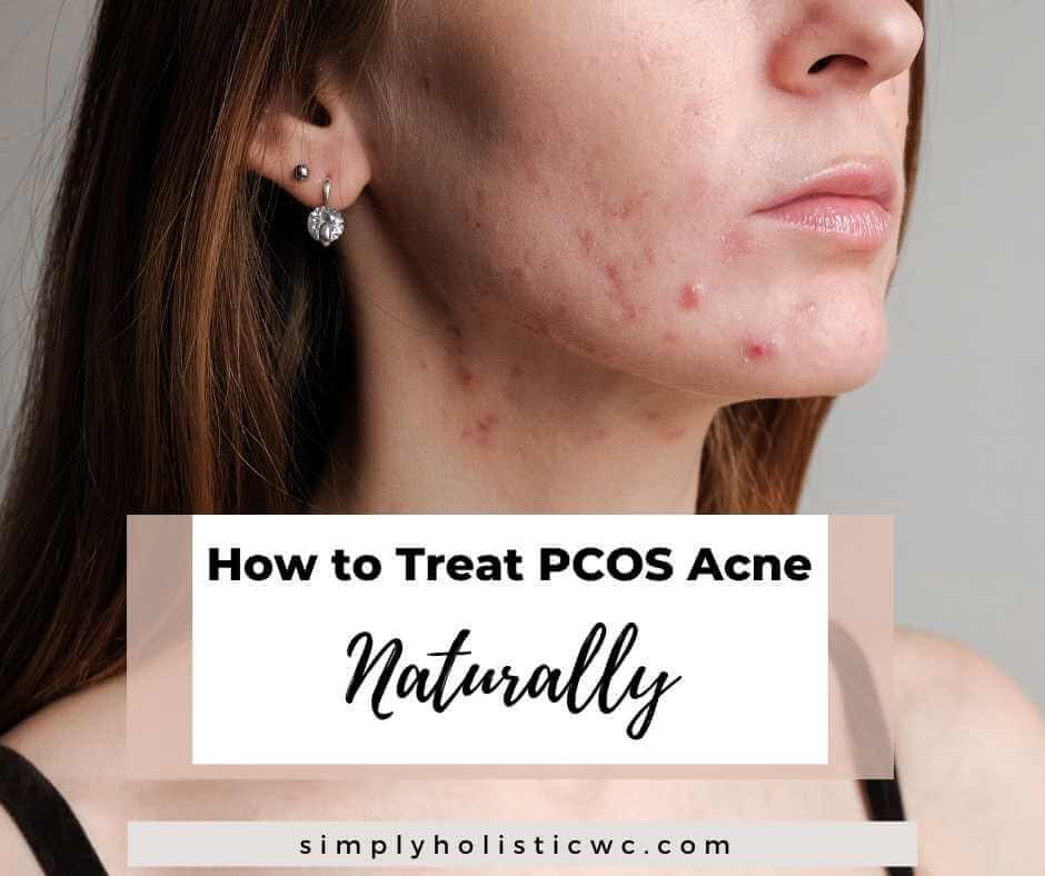 PCOS Acne: What Causes It And 19 Ways To Treat It Naturally - Simply ...